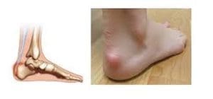 Heel Spurs: A Helpful Guide | Causes, Symptoms and Treatment - Double ...