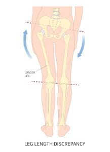 Leg Length Discrepancies: A Helpful Podiatry Guide