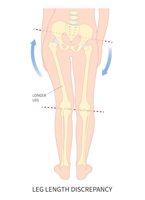 Leg Length Discrepancies: A Helpful Podiatry Guide