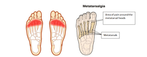 Metatarsalgia: A Helpful Guide | Causes, Symptoms and Treatment ...