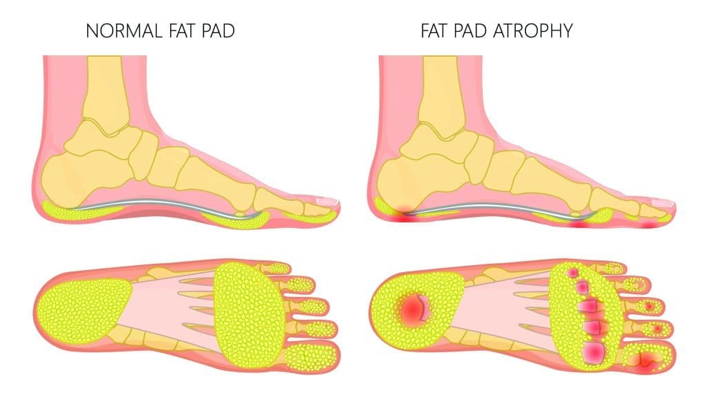 Fat Pad Atrophy: A Helpful Guide | Causes, Symptoms and Treatment ...