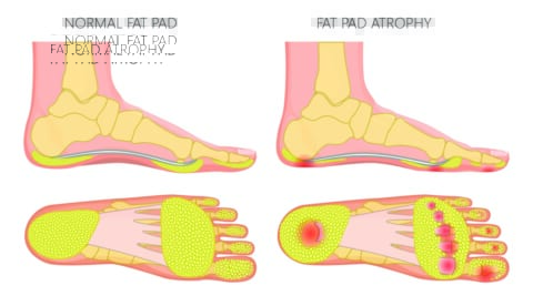 Fat Pad Atrophy A Helpful Guide Causes Symptoms And Treatment Double Bay Podiatry