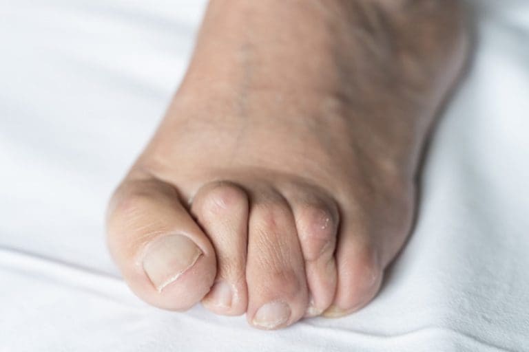 Hammertoes: A Helpful Guide | Causes, Symptoms & Treatments